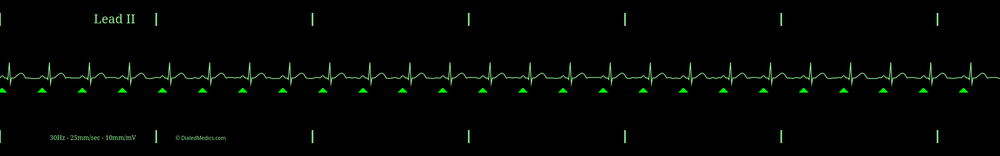 The Normal Sinus Rhythm (NSR) ECG/EKG