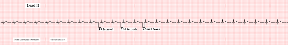 The Normal Sinus Rhythm (NSR) ECG/EKG
