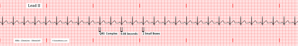 The Normal Sinus Rhythm (NSR) ECG/EKG