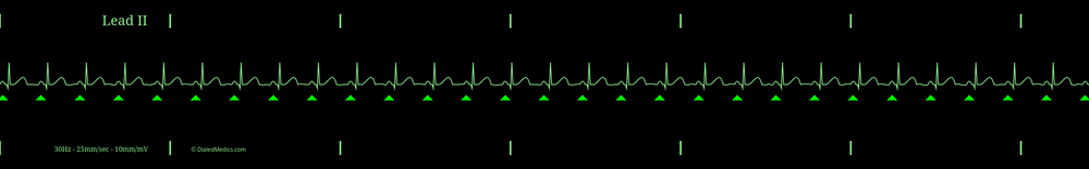 The Normal Sinus Rhythm (NSR) ECG/EKG