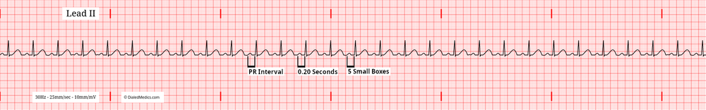 The Normal Sinus Rhythm (NSR) ECG/EKG