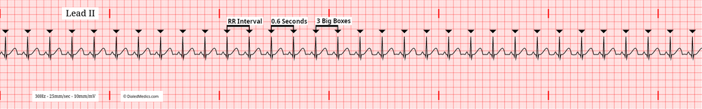 The Normal Sinus Rhythm (NSR) ECG/EKG