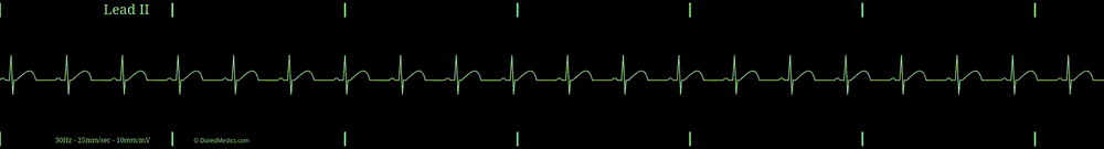The Normal Sinus Rhythm (NSR) EKG/ECG