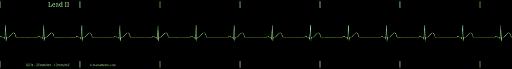 The Sinus Bradycardia EKG/ECG