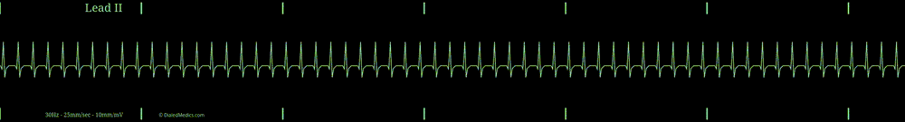 The Supraventricular Tachycardia (SVT) EKG/ECG