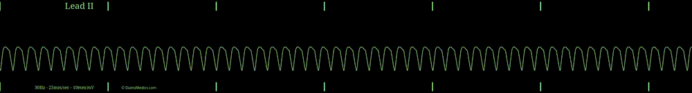 The Ventricular Tachycardia EKG/ECG