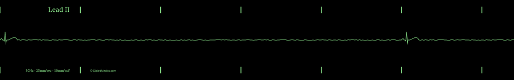The Sinus Bradycardia ECG/EKG
