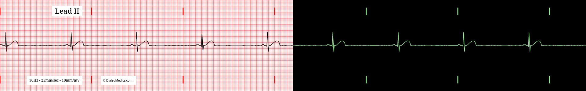 The Sinus Bradycardia ECG/EKG