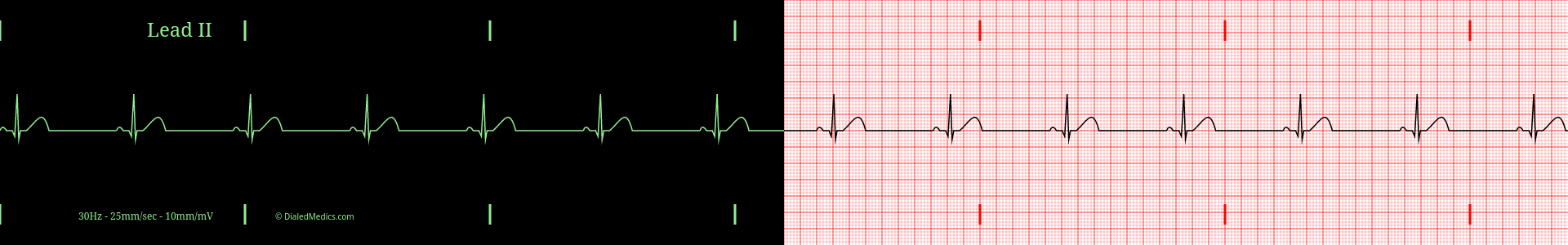 The Sinus Bradycardia ECG/EKG