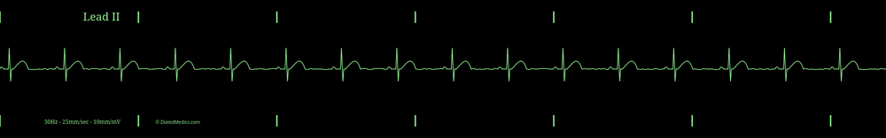 The Sinus Bradycardia ECG/EKG