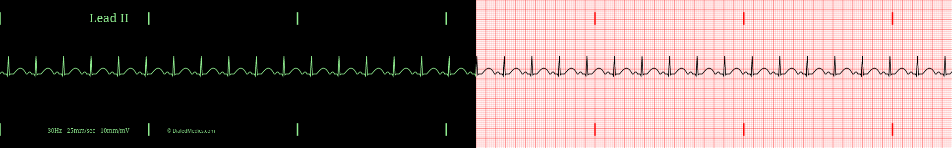 The Sinus Tachycardia ECG/EKG