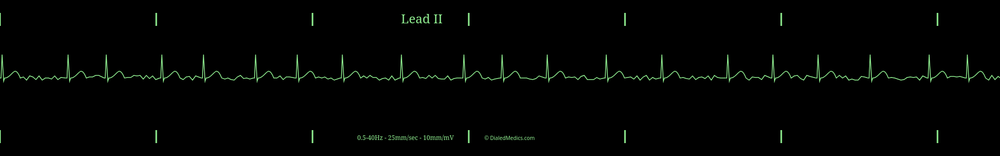 The Atrial Fibrillation (AF) ECG/EKG
