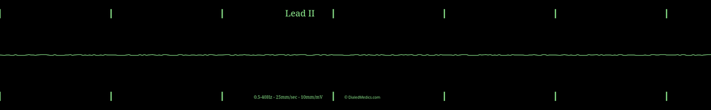 The Asystole ECG/EKG