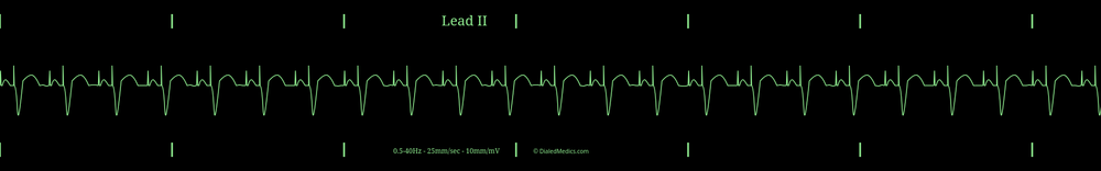 The Atrio-Ventricular Pacemaker EKG/ECG