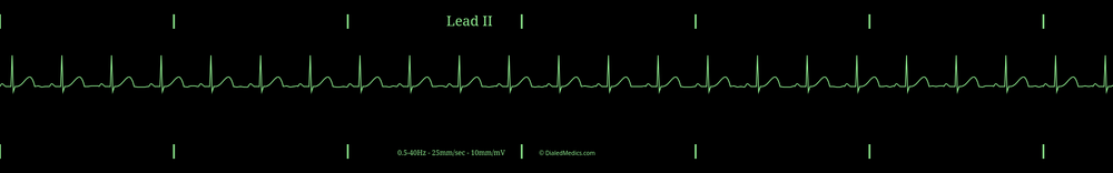 The Normal Sinus Rhythm (NSR) ECG/EKG