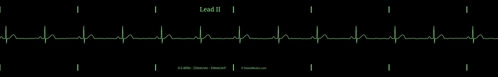 The Sinus Bradycardia ECG/EKG