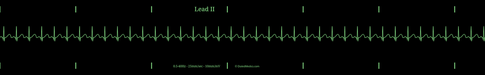 The Sinus Tachycardia ECG/EKG