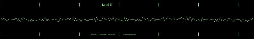 The Ventricular Fibrillation (VF) ECG/EKG