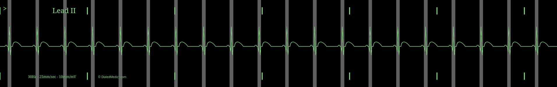 The Normal Sinus Rhythm (NSR) EKG/ECG