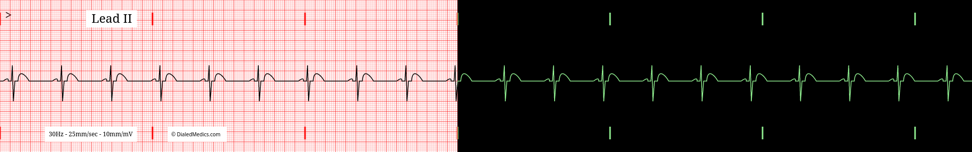 The Normal Sinus Rhythm (NSR) EKG/ECG