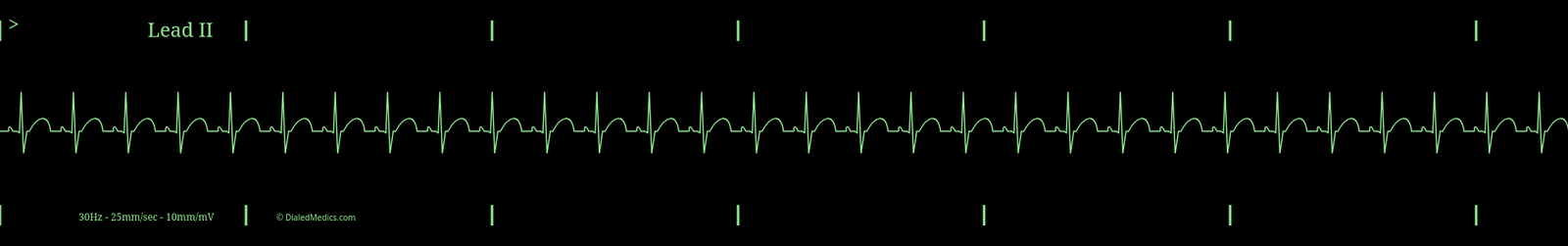 The Normal Sinus Rhythm (NSR) EKG/ECG