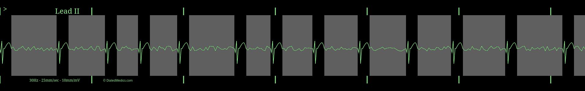 The Atrial Fibrillation (AF) ECG/EKG