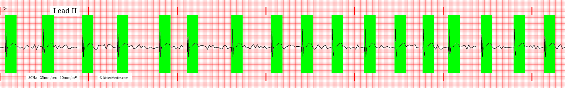 The Atrial Fibrillation (AF) ECG/EKG