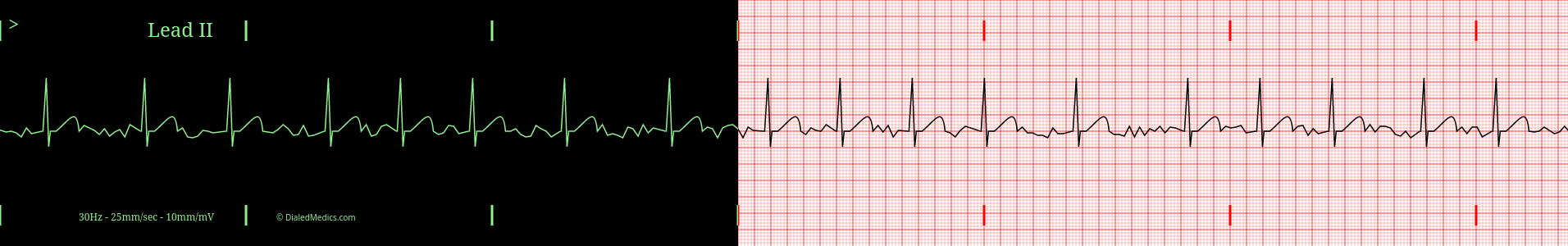 The Atrial Fibrillation (AF) ECG/EKG