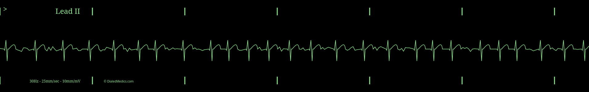 The Atrial Fibrillation (AF) ECG/EKG
