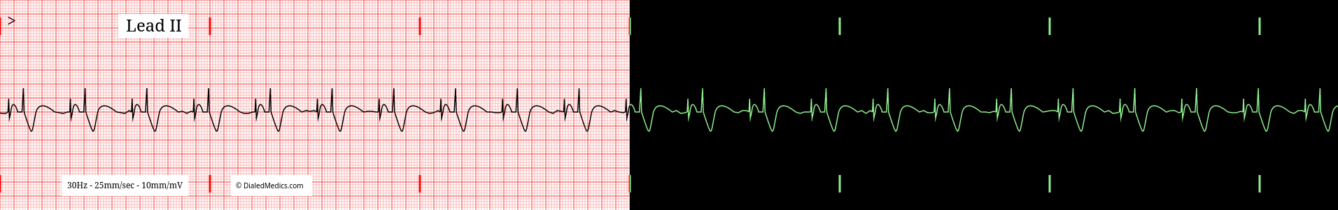 The Atrio-Ventricular Pacemaker EKG/ECG