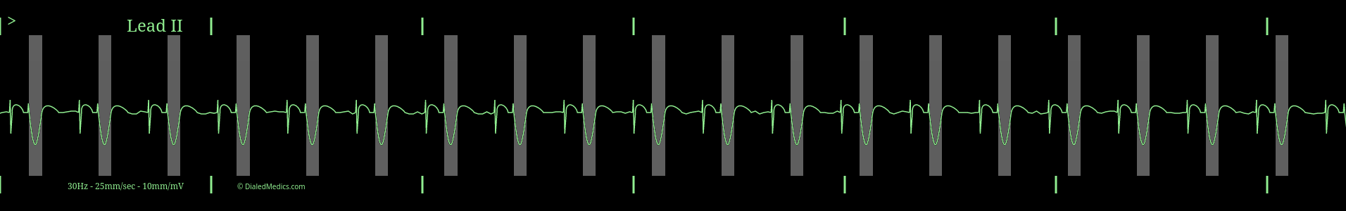 The Atrio-Ventricular Pacemaker EKG/ECG