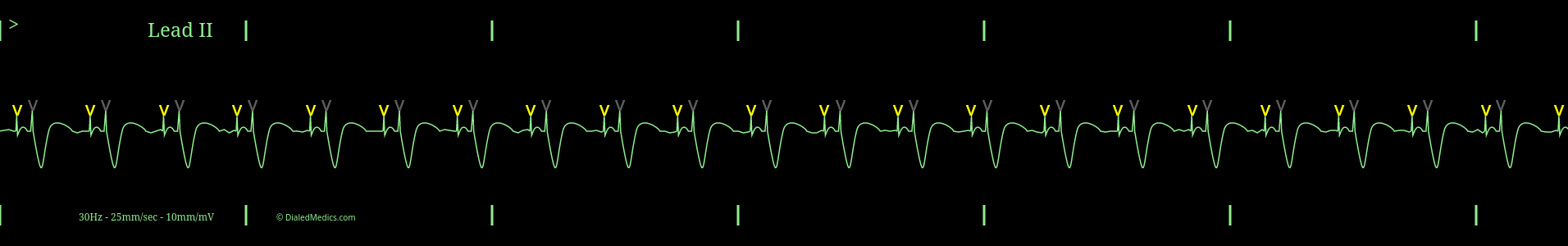 The Atrio-Ventricular Pacemaker EKG/ECG