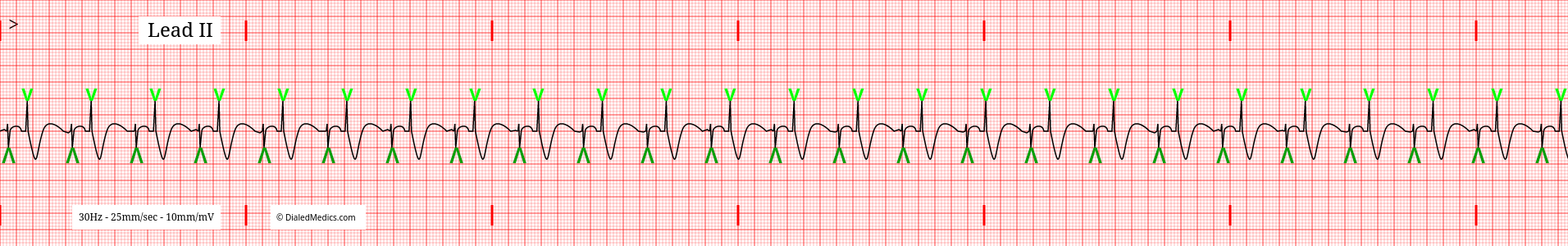 The Atrio Ventricular Pacemaker Ekgecg