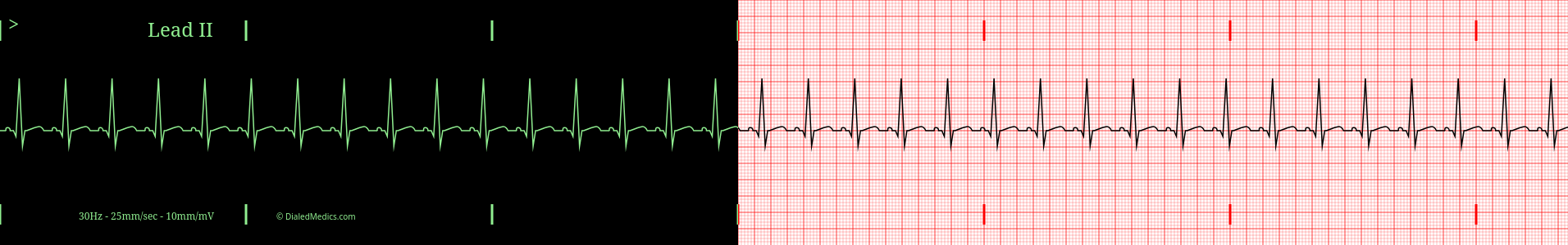 The Sinus Tachycardia EKG/ECG