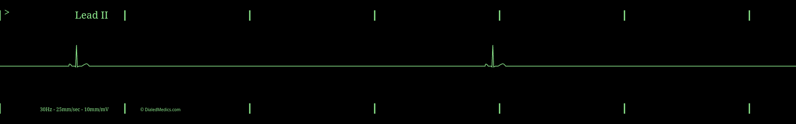 The Sinus Bradycardia EKG/ECG
