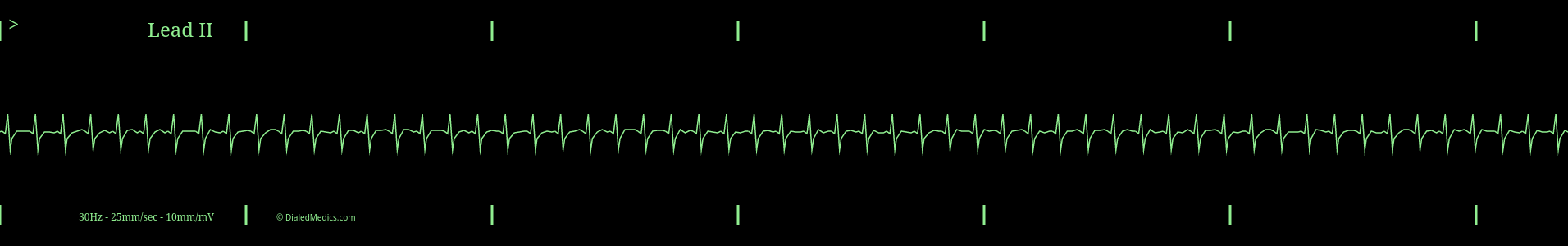 The Supraventricular Tachycardia (SVT) ECG/EKG