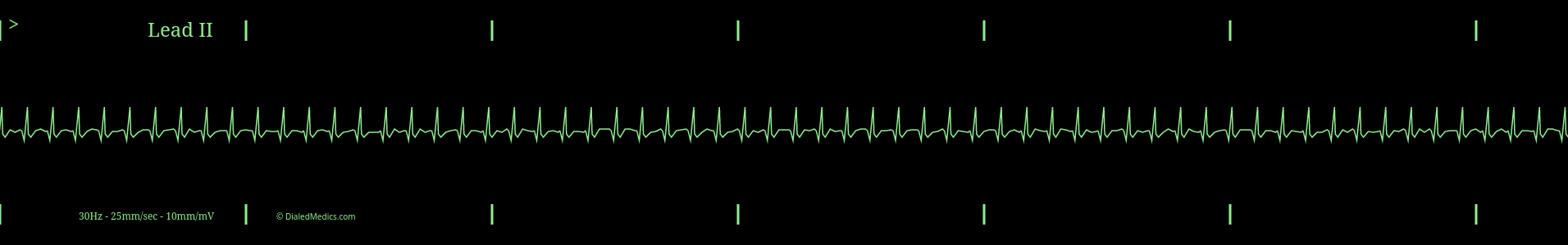 The Supraventricular Tachycardia (SVT) ECG/EKG