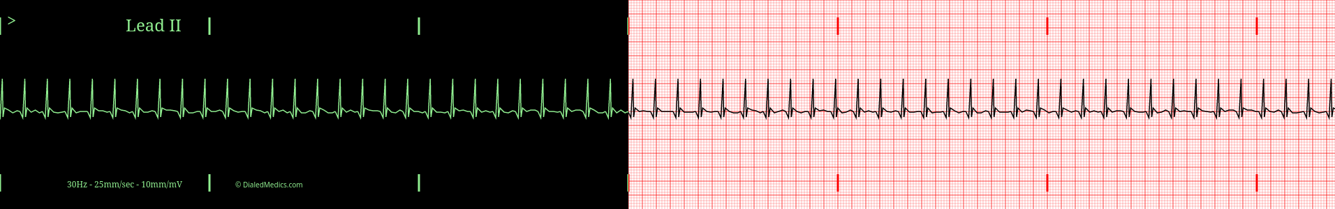 The Supraventricular Tachycardia (SVT) ECG/EKG
