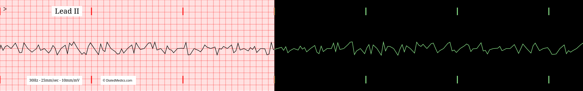 The Ventricular Fibrillation (VF) ECG/EKG