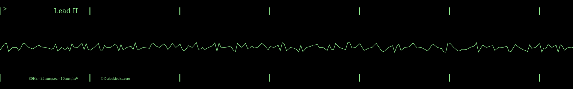 The Ventricular Fibrillation (VF) ECG/EKG