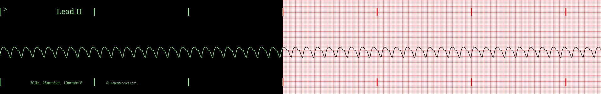 The Ventricular Tachycardia ECG/EKG