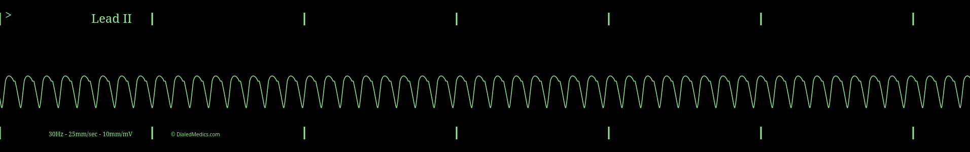 The Ventricular Tachycardia ECG/EKG