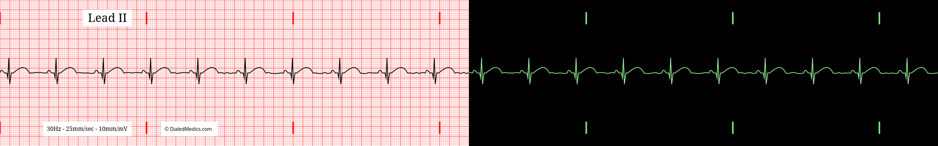 The Normal Sinus Rhythm (NSR) ECG/EKG