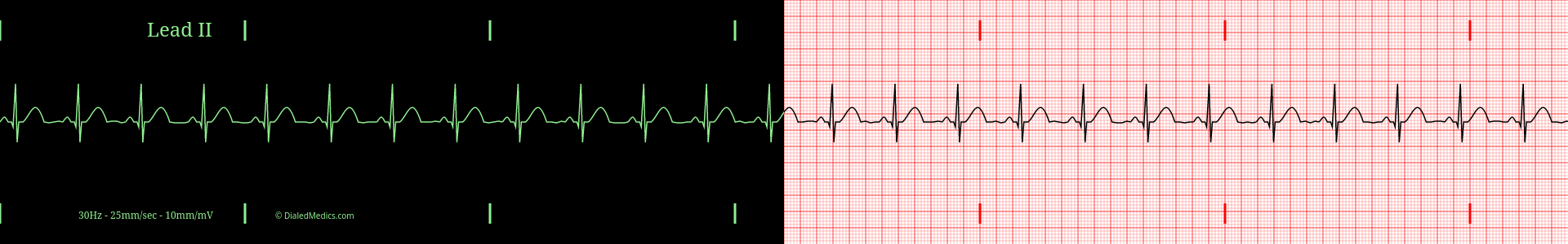 The Normal Sinus Rhythm (NSR) ECG/EKG