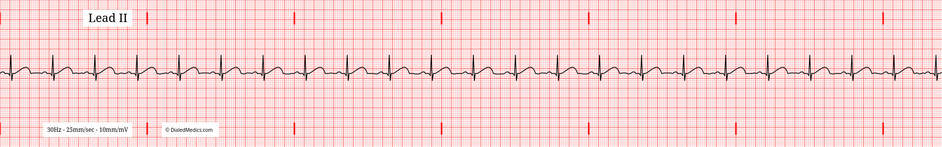The Normal Sinus Rhythm (NSR) ECG/EKG