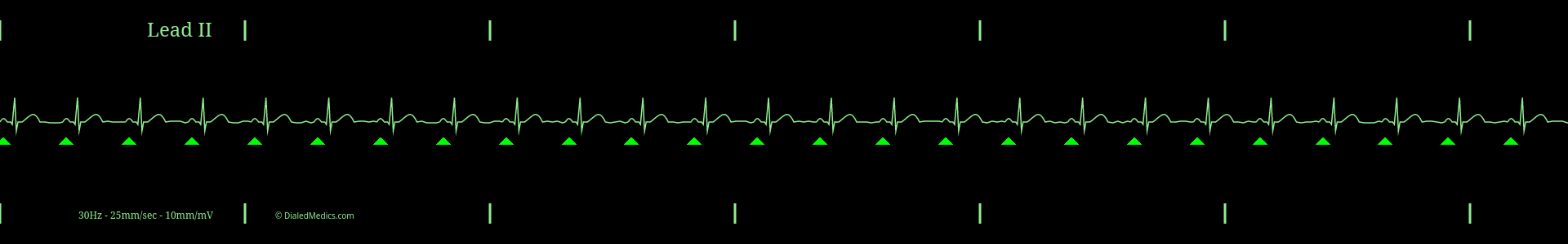 The Normal Sinus Rhythm (NSR) ECG/EKG
