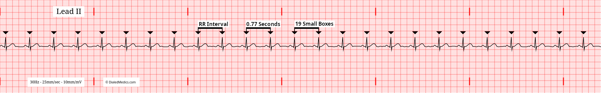 The Normal Sinus Rhythm (NSR) ECG/EKG