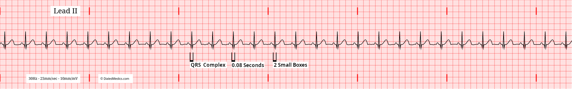 The Normal Sinus Rhythm (NSR) ECG/EKG