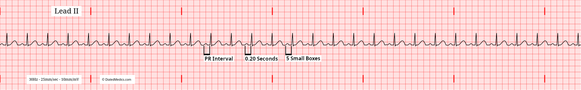 The Normal Sinus Rhythm (NSR) ECG/EKG