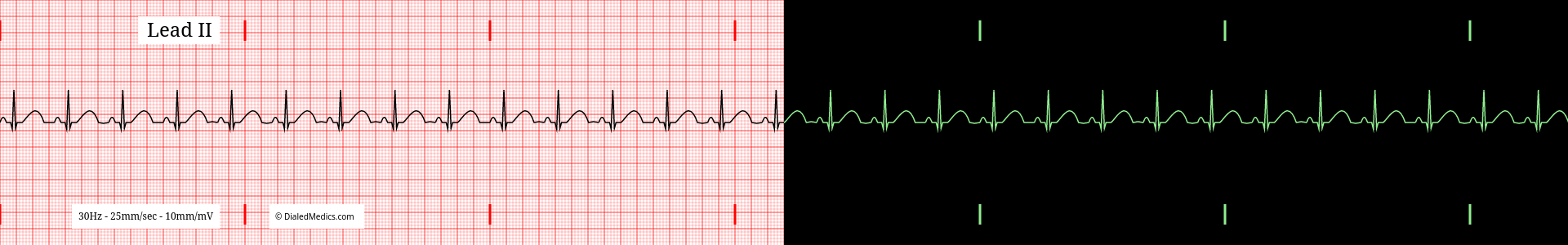 The Normal Sinus Rhythm (NSR) ECG/EKG